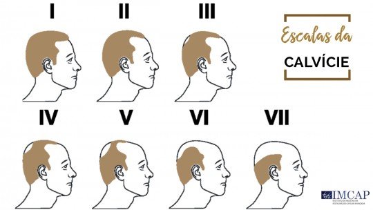 ESCALAS DA CALVÍCIE | Transplante Capilar Curitiba